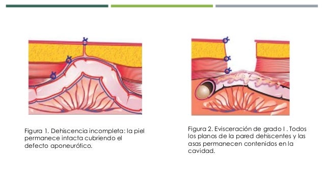 COMPLICACIONES QUIRÚRGICAS - UPAO