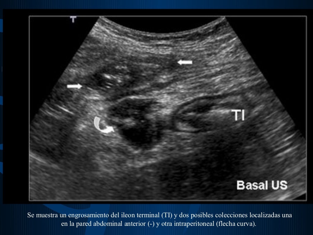 Complicaciones quirurgicas de cirugia abdominal Complicaciones quirurgicas de cirugia abdominal