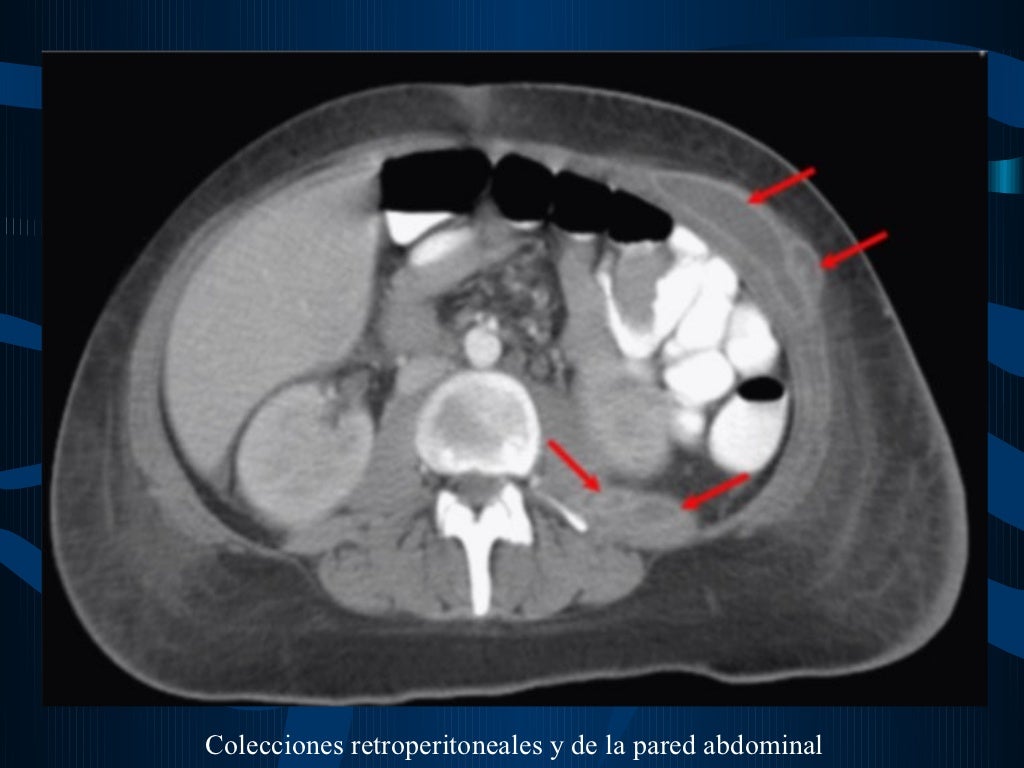 Complicaciones quirurgicas de cirugia abdominal Complicaciones quirurgicas de cirugia abdominal