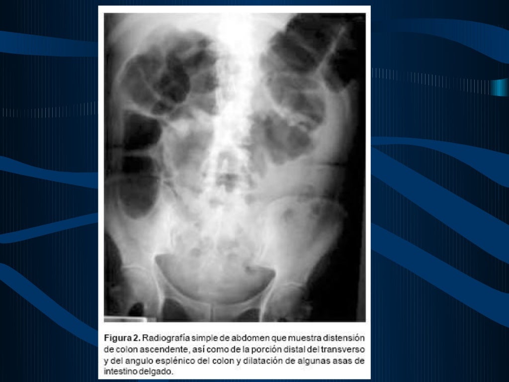 Complicaciones quirurgicas de cirugia abdominal Complicaciones quirurgicas de cirugia abdominal
