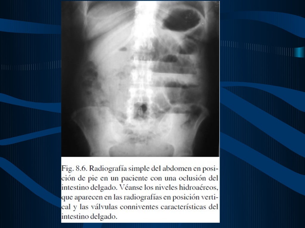 Complicaciones quirurgicas de cirugia abdominal Complicaciones quirurgicas de cirugia abdominal