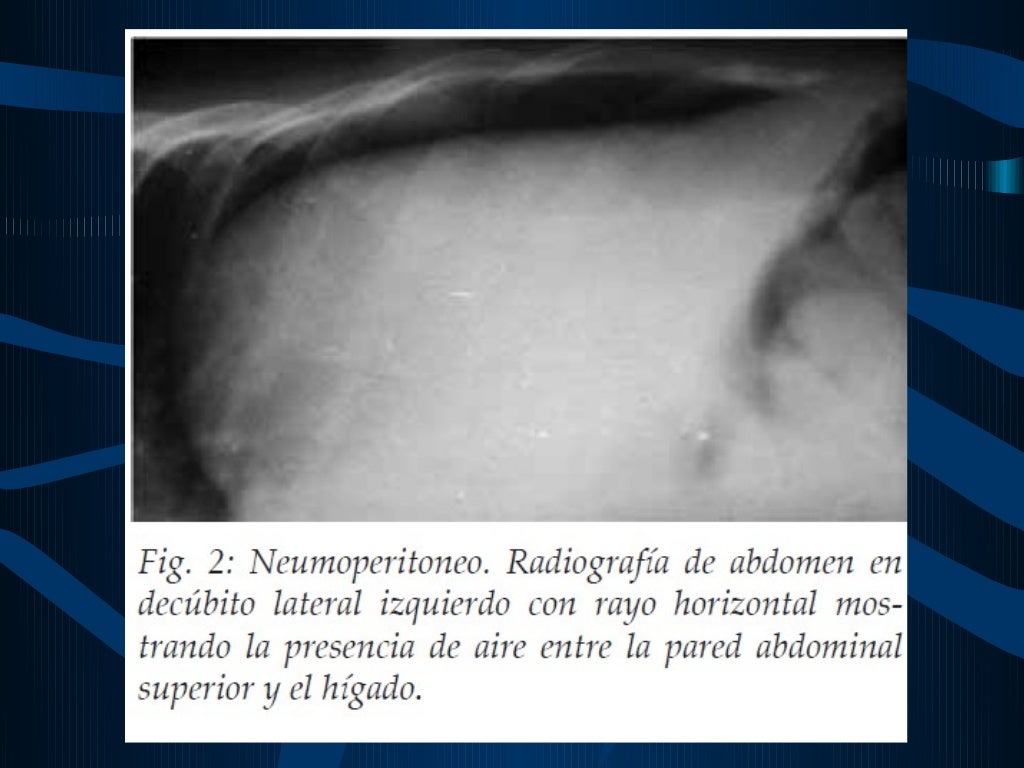 Complicaciones quirurgicas de cirugia abdominal Complicaciones quirurgicas de cirugia abdominal