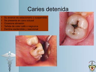 Complicaciones y clasificacion de la caries | PPTX