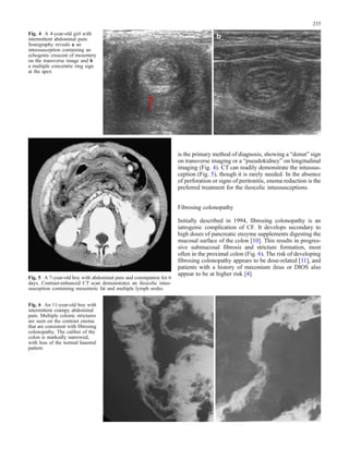 complicaiones Gastrointestinales Fibrosis quistica | PDF