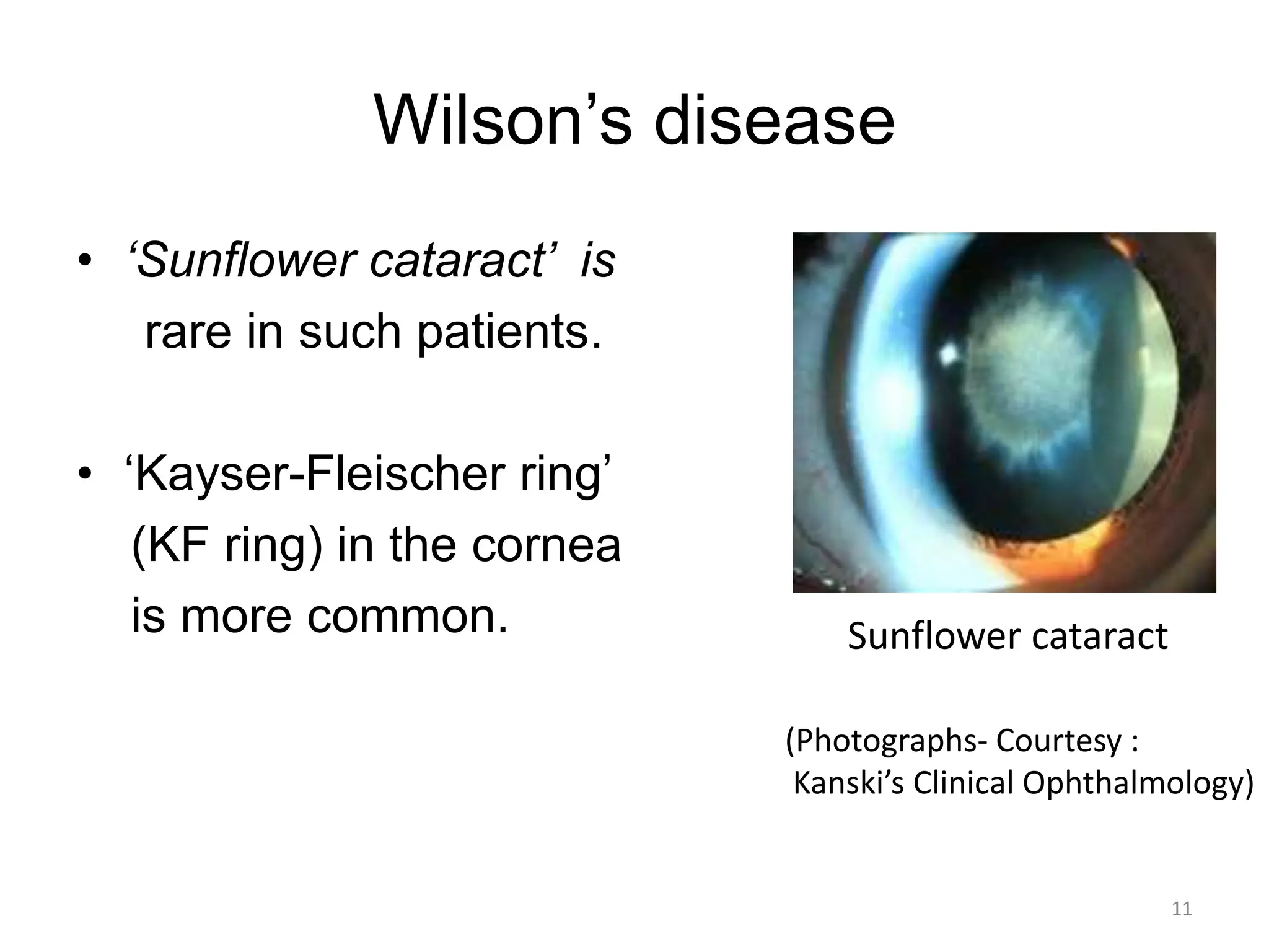 complicated_cataract. Presentation slide | PPTX