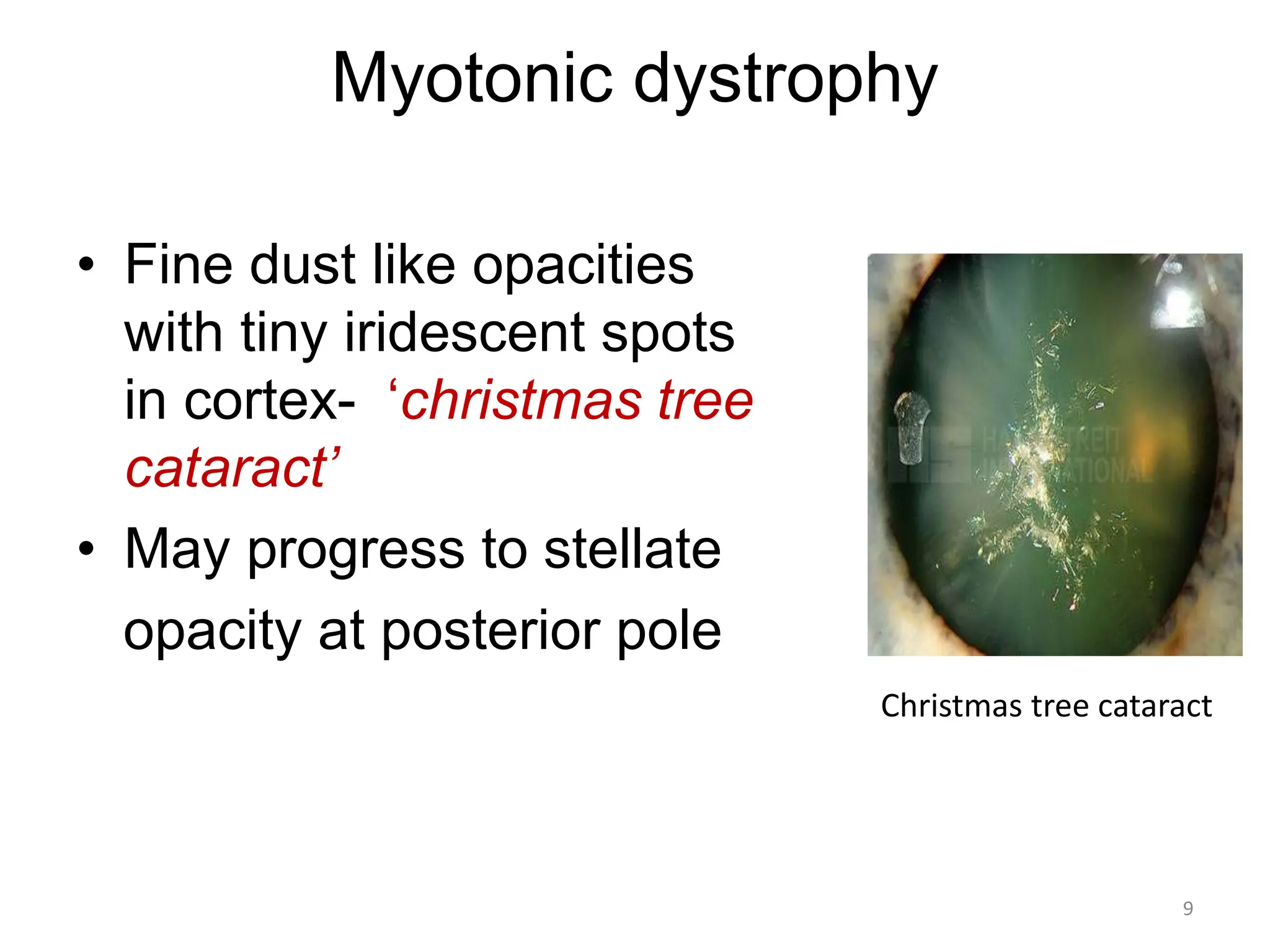 complicated_cataract. Presentation slide | PPTX