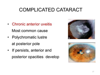 complicated_cataract. Presentation slide | PPTX