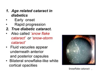 complicated_cataract. Presentation slide | PPTX
