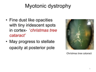 complicated_cataract. Presentation slide | PPTX