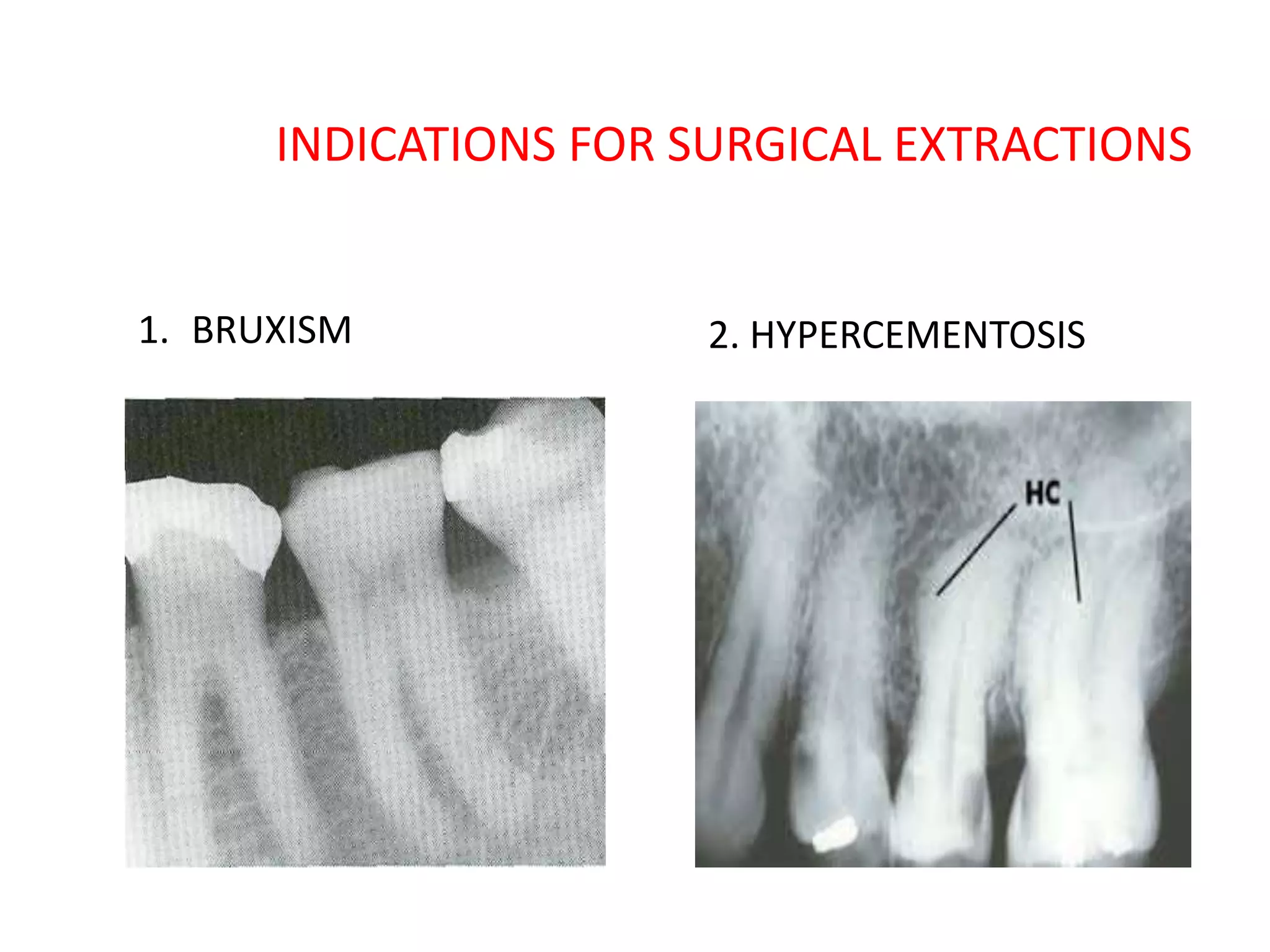 principles of complicated exodontia | PPTX