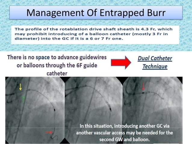 Complication and management of rotablation | PPT