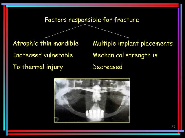 Complication & Failure of Implants in prosthodontics | PPT