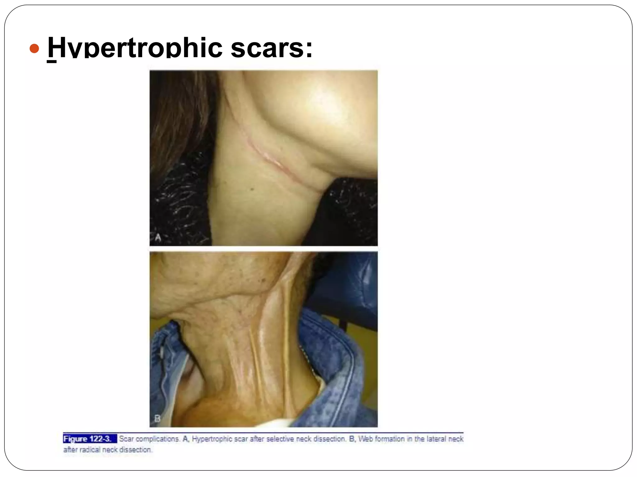 Complication neck dissection | PPTX
