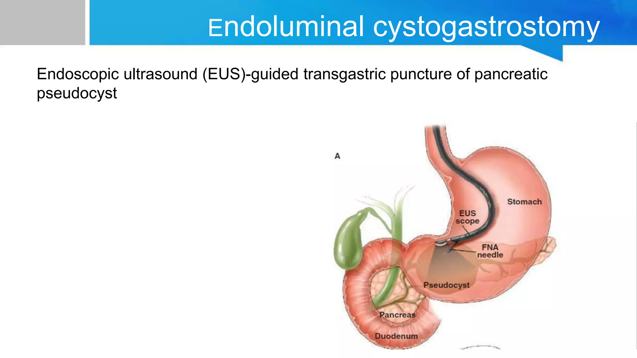 Complication Of Acute Pancreatitis | PPTX