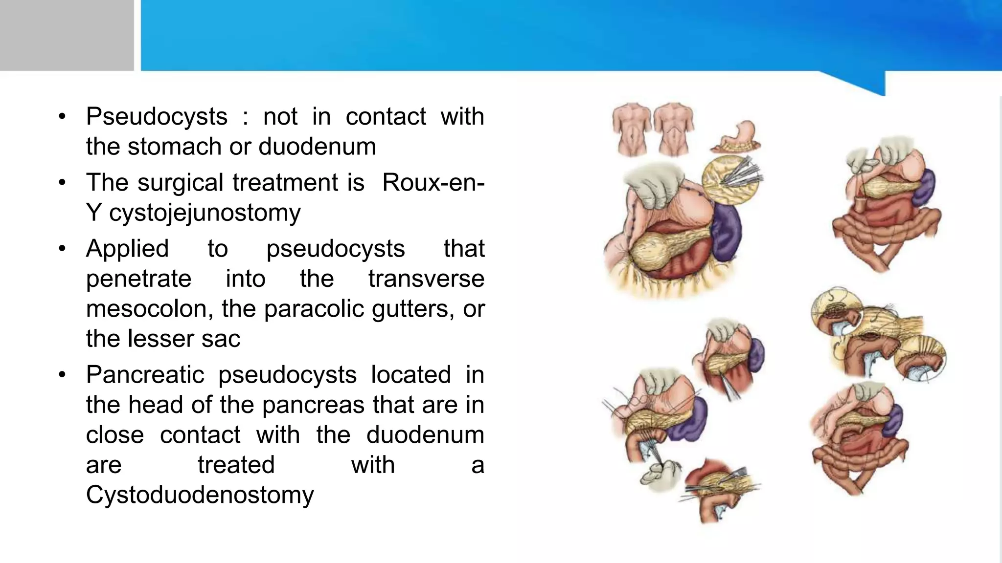 Complication Of Acute Pancreatitis | PPTX