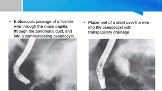 Complication Of Acute Pancreatitis | PPTX