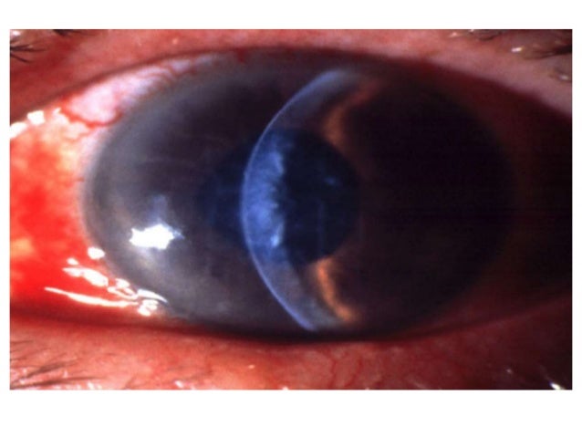Complication of cataract surgery