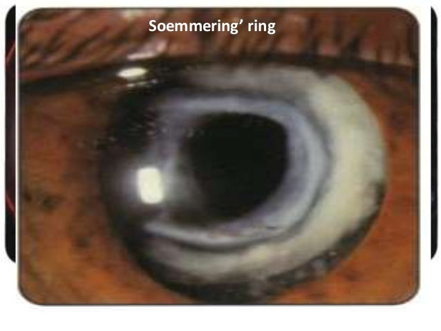 Complication of cataract surgery