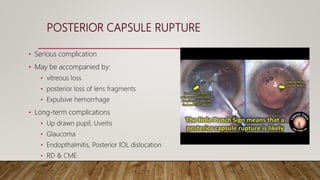 Complication of catarct surgery | PPTX