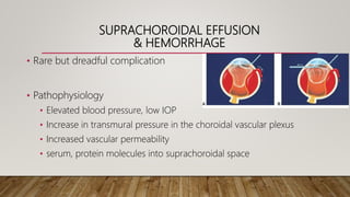 Complication of catarct surgery | PPTX