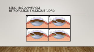 Complication of catarct surgery | PPTX