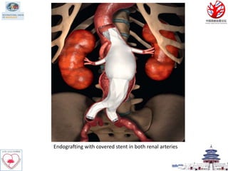 Complications of fenestrated endovascular aneurysm repair- a case study ...