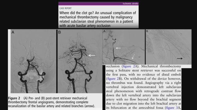 Complication of EVT.pdf