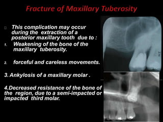 Complication of Exodontia.pptx