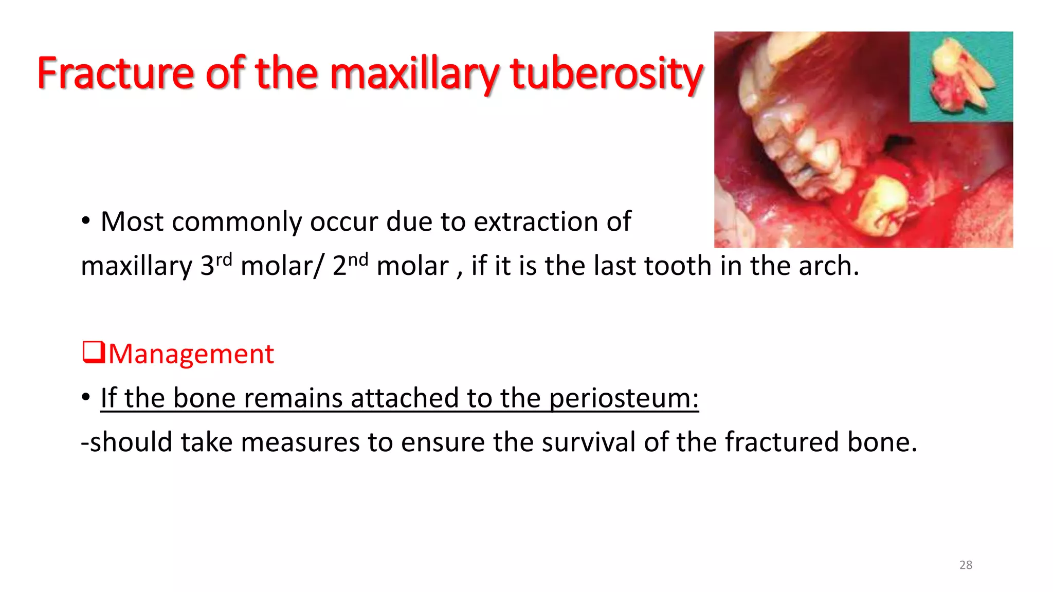 Complication of extraction | PPTX