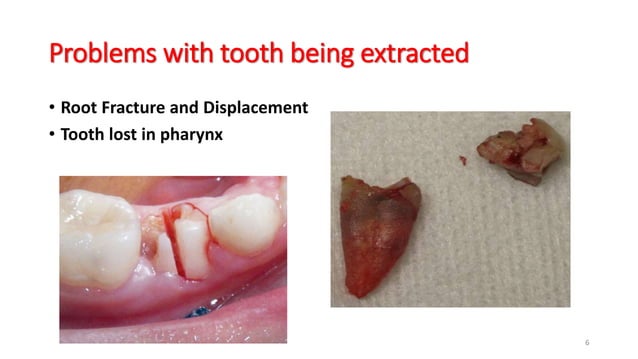 Complication of extraction | PPTX
