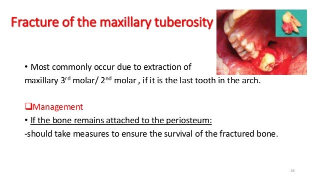 Complication of extraction