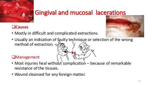 Complication of extraction