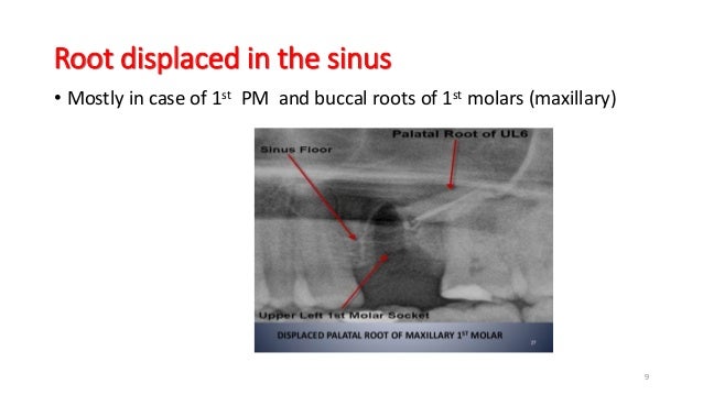 Complication of extraction