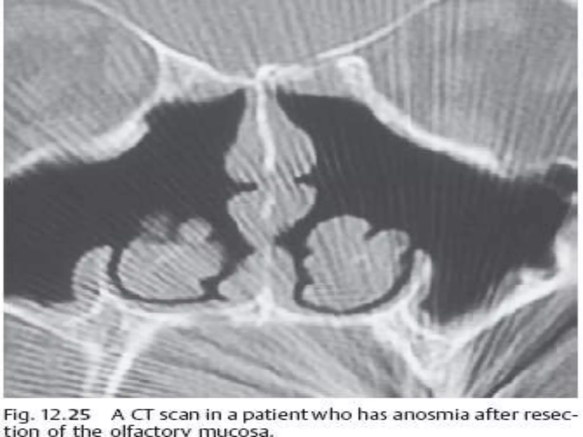 Complication of fess | PPTX