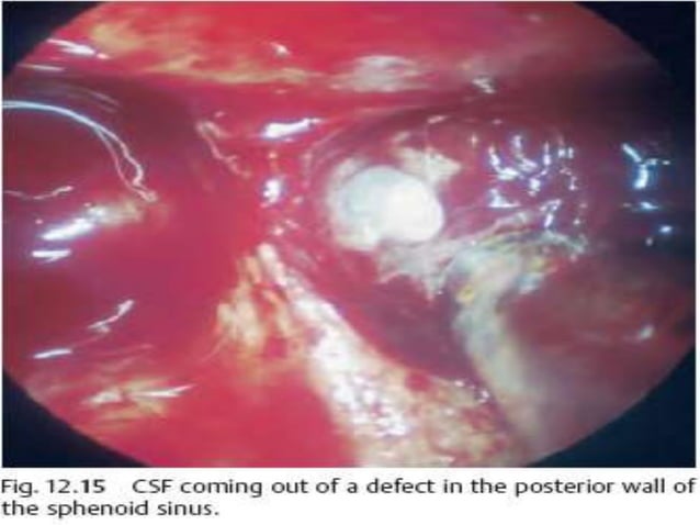 Complication of fess | PPTX