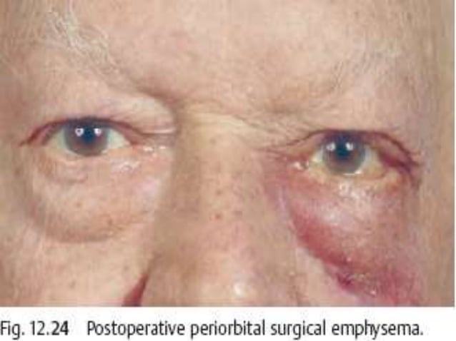 Complication of fess | PPTX