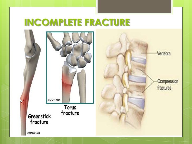Comminuted Fracture Common Location Hisatable