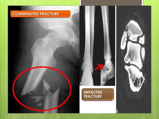Complication of fracture | PPT