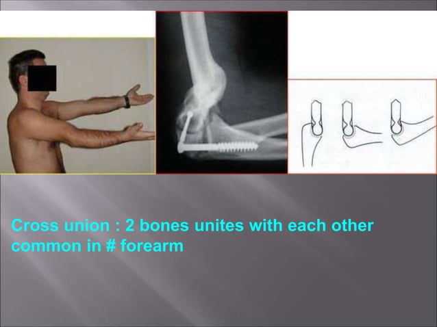 complication of fractures.ppt