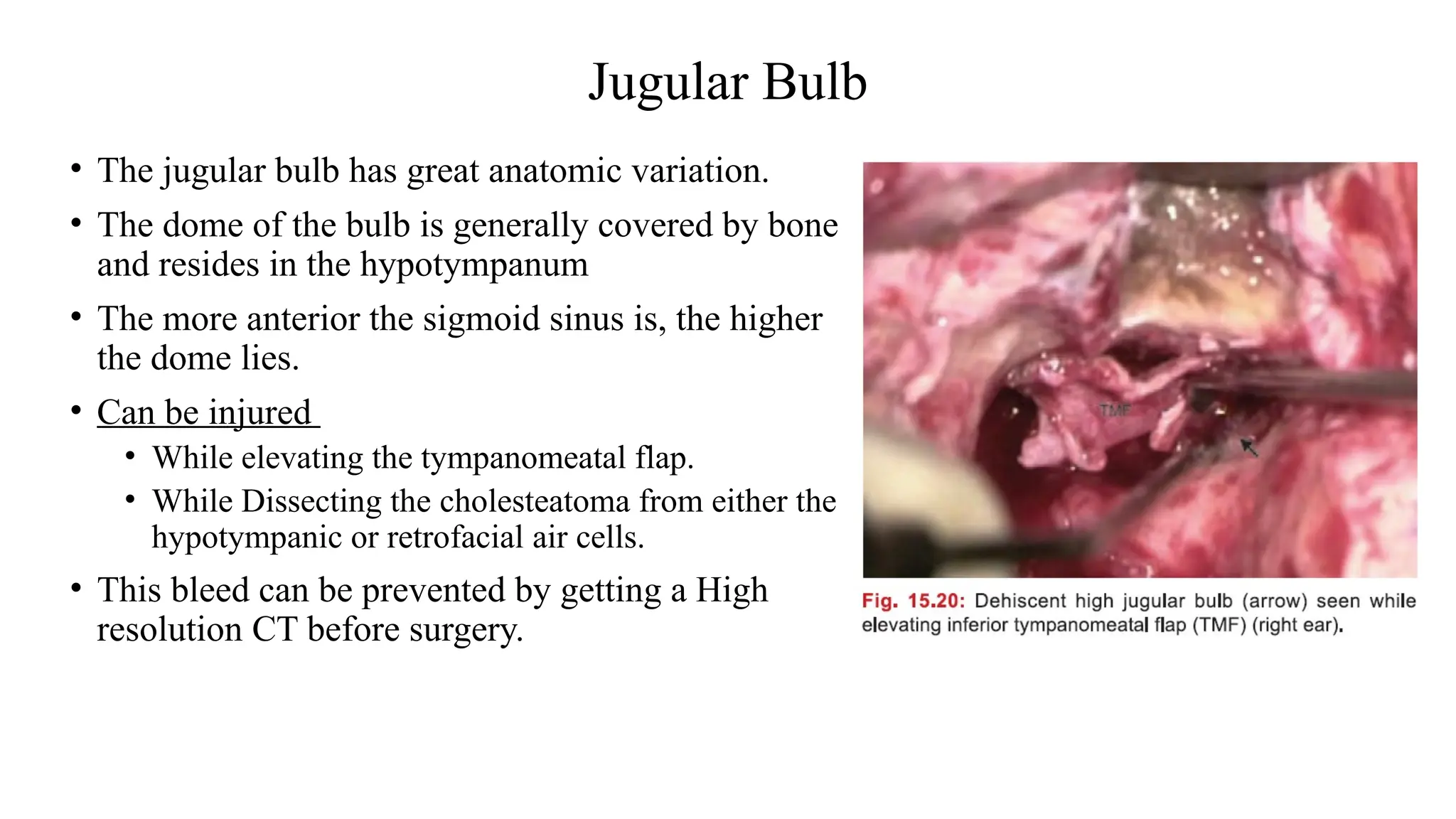complication of mastoid surgery final.pptx