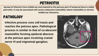 Complications of csom otitis media .pdf