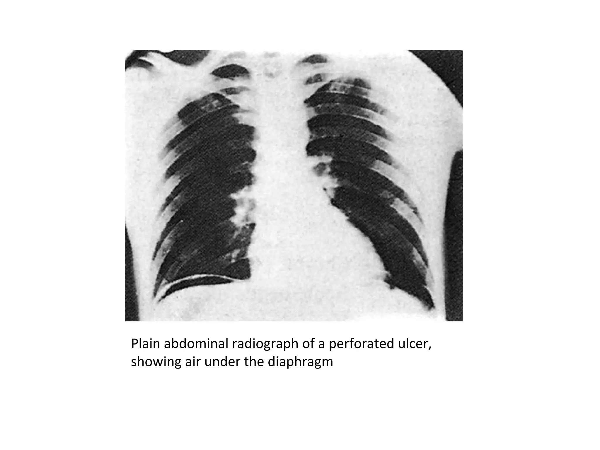 Complications of-peptic-ulcer | PPT