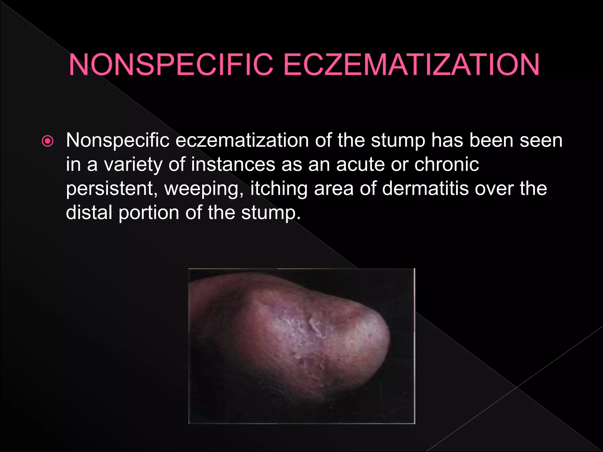 Complications After Amputation Pptx