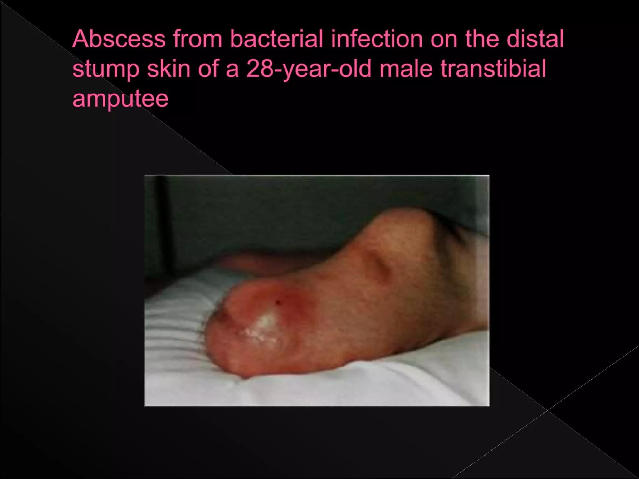 Complications After Amputation.pptx