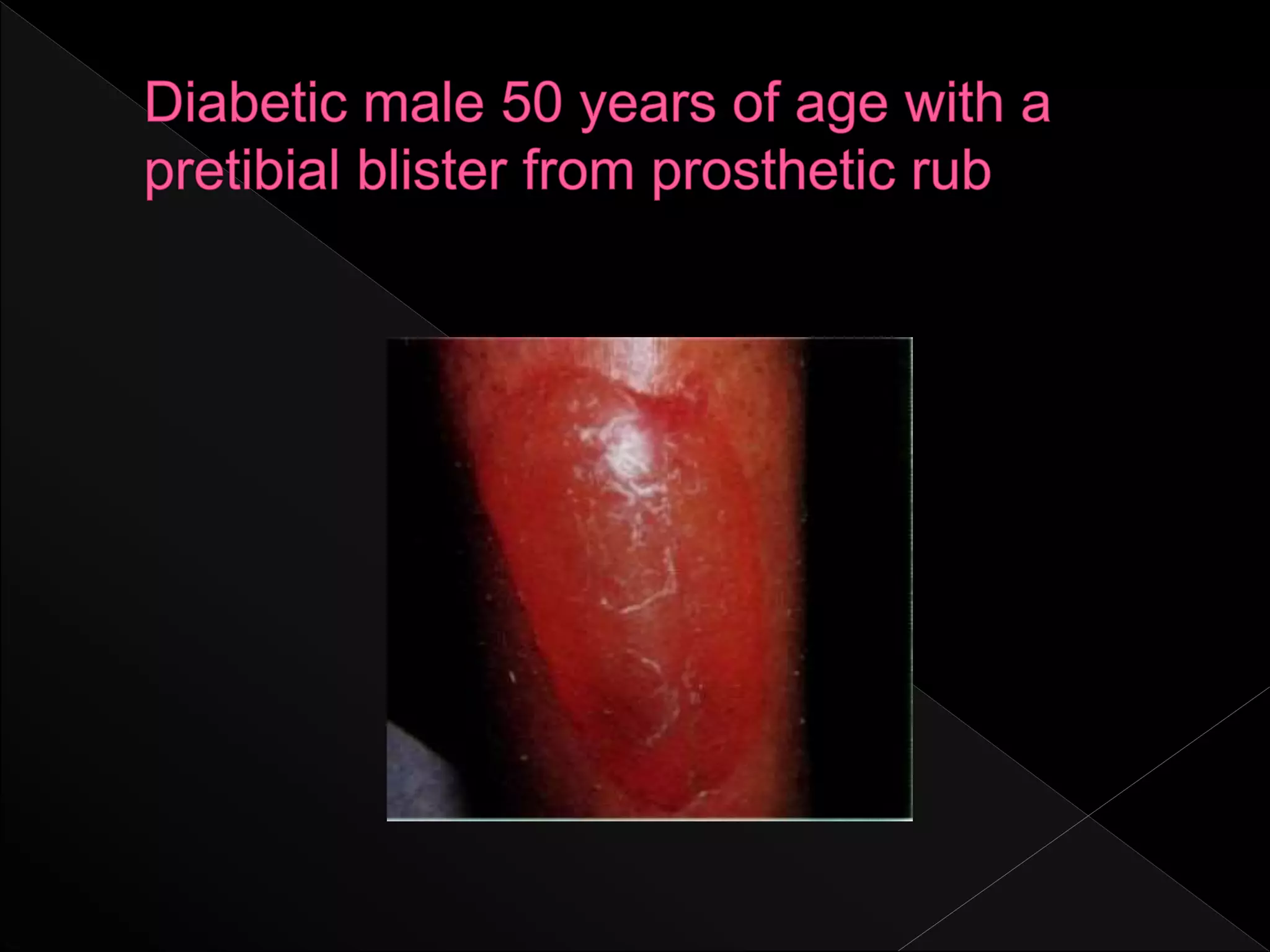 Complications After Amputation Pptx