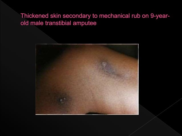 Complications After Amputation Pptx