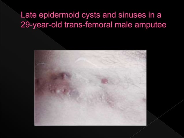 Complications After Amputation.pptx