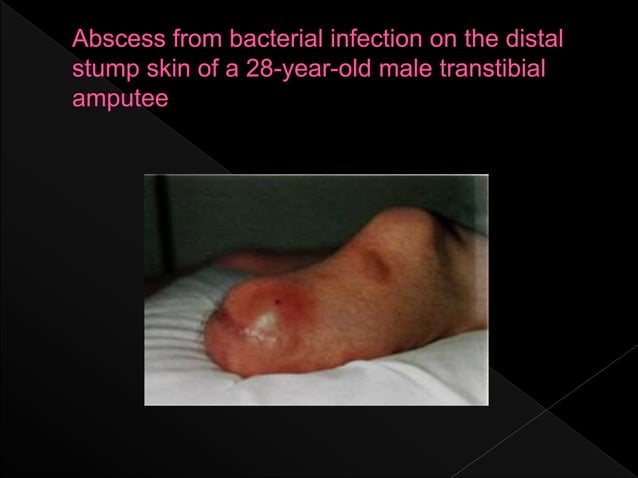 Complications After Amputation Pptx