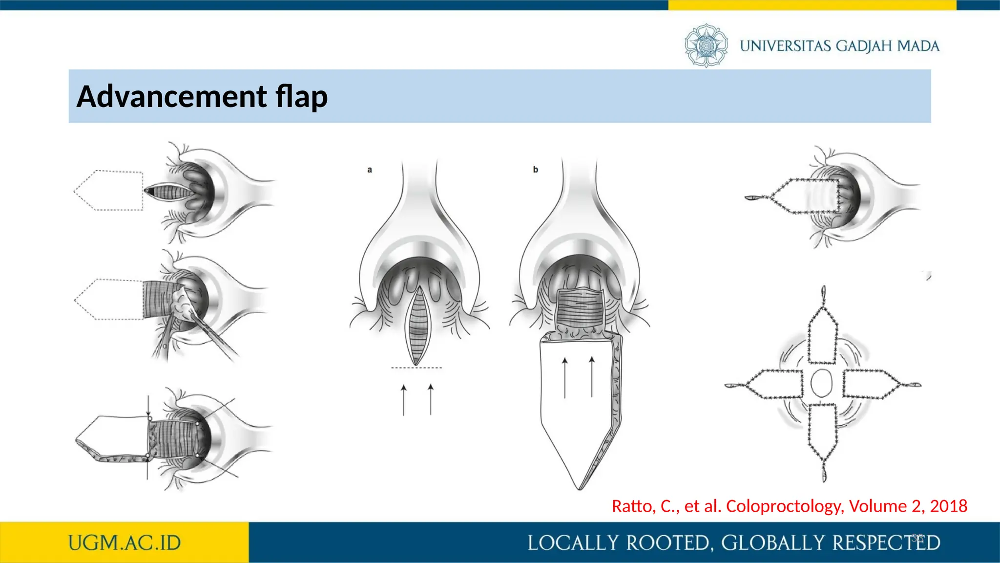 Complications After Hemorrhoid Surgery UGM pptx