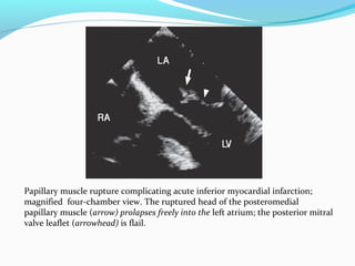 Complications ami | PPT